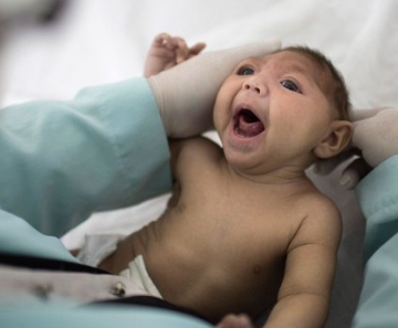 PE apresenta 26% dos casos de bebês com microcefalia do Brasil